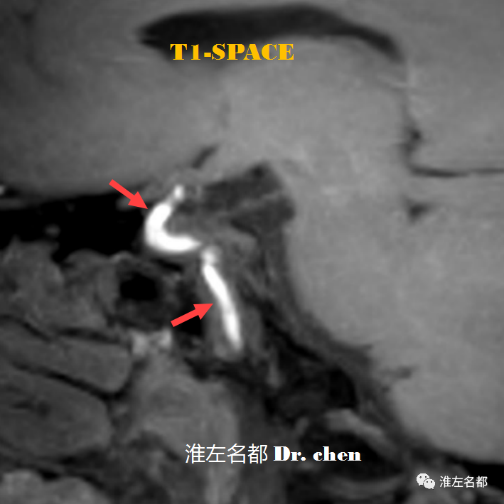 颈动脉闭塞导致脑、视神经和视交叉梗死_医学界-助力医生临床决策和职业成长