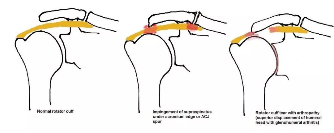 解剖丨Acromial types （肩峰分型）_医学界-助力医生临床决策和职业成长