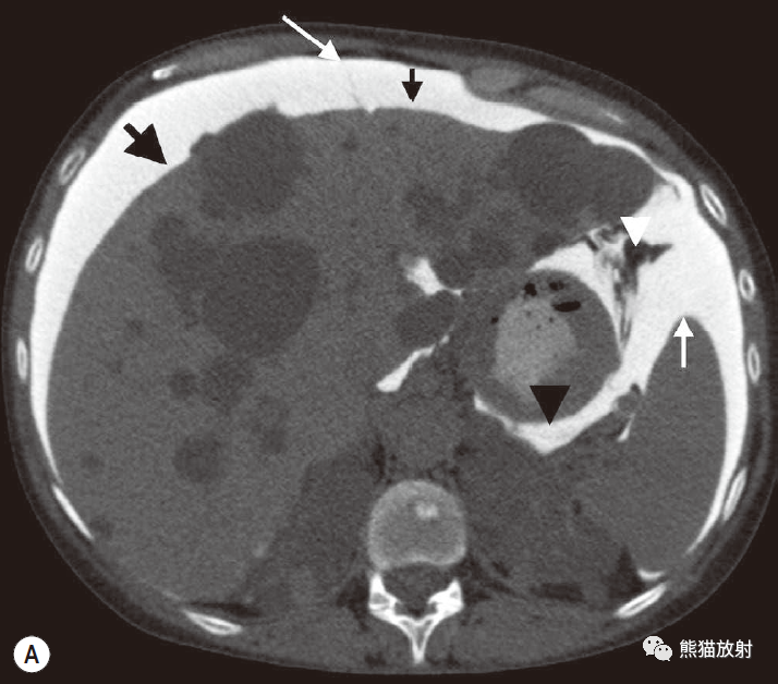 被囊性腹膜硬化症 – 被嚢性腹膜硬化症 文献 – NASLEMM