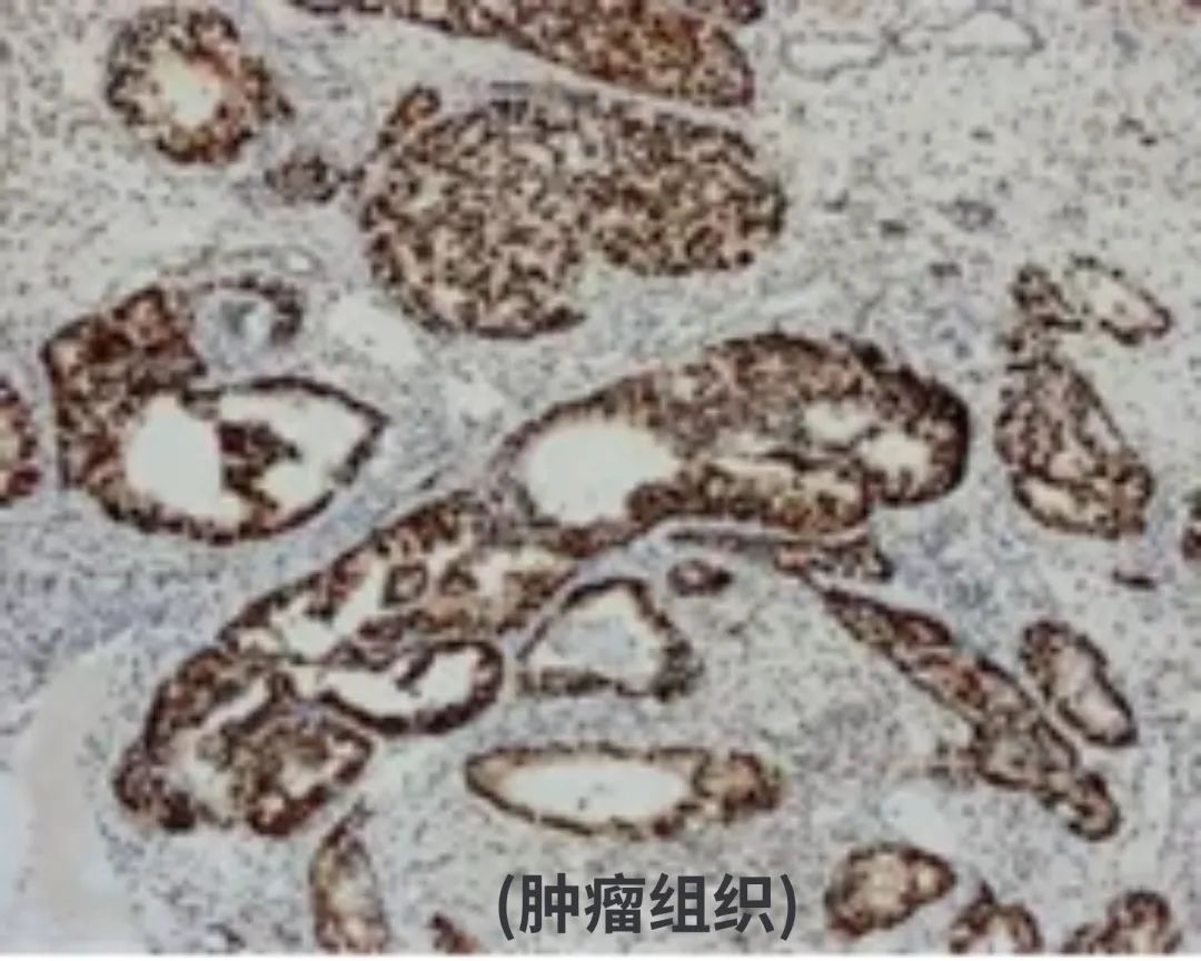 病理干货 | 简述pan-TRK免疫组化检测应用与判读_医学界-助力医生临床决策和职业成长