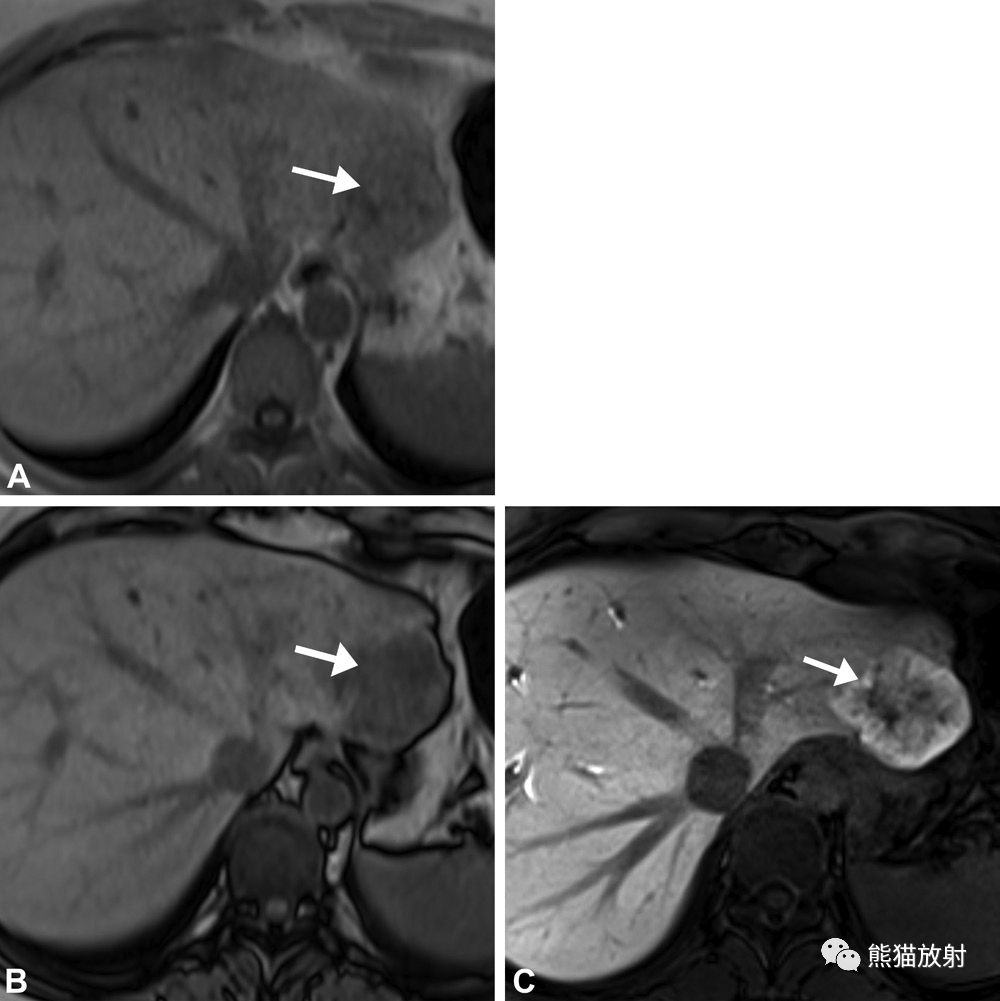 FNH及FNH样病变：影像表现_医学界-助力医生临床决策和职业成长