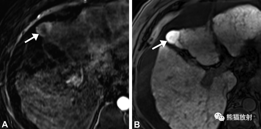 FNH及FNH样病变：影像表现_医学界-助力医生临床决策和职业成长