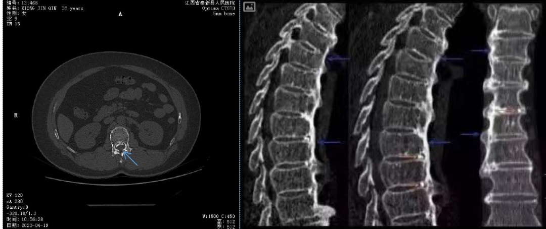 这种往往会报骨质增生的情况，其实是 DISH_医学界-助力医生临床决策和职业成长