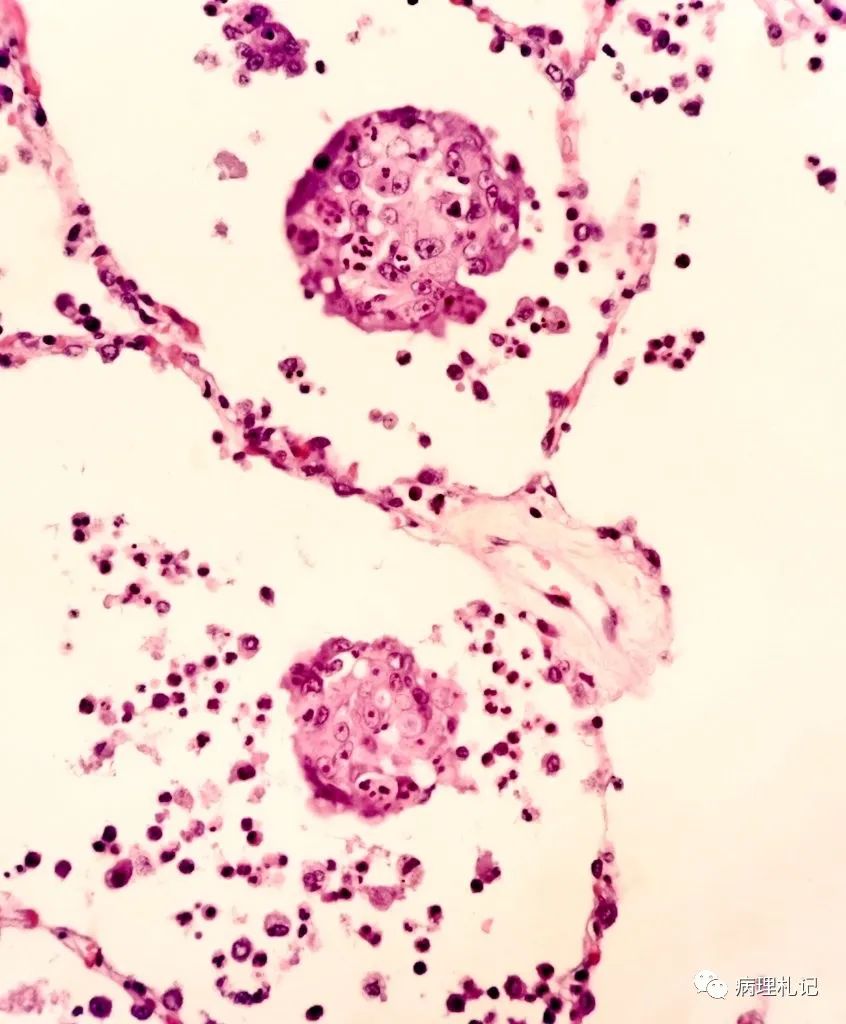 病理视角|肺（微）乳头状腺癌 空中传播空间（STAS）_医学界-助力医生临床决策和职业成长