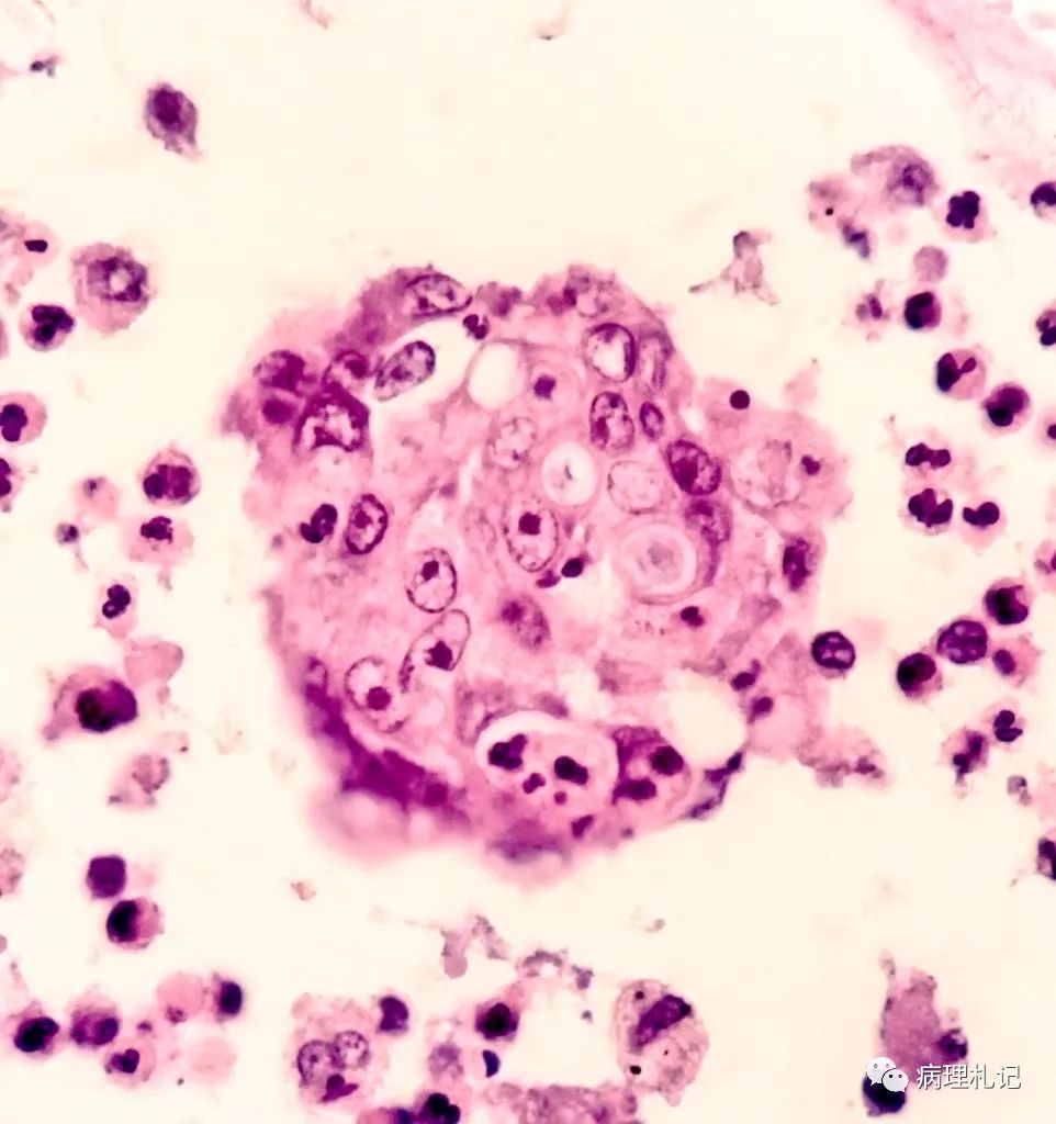 病理视角|肺（微）乳头状腺癌 空中传播空间（STAS）_医学界-助力医生临床决策和职业成长