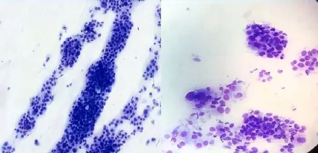 【衡道丨笔记】纤支镜检查中ROSE诊断的开展_医学界-助力医生临床决策和职业成长