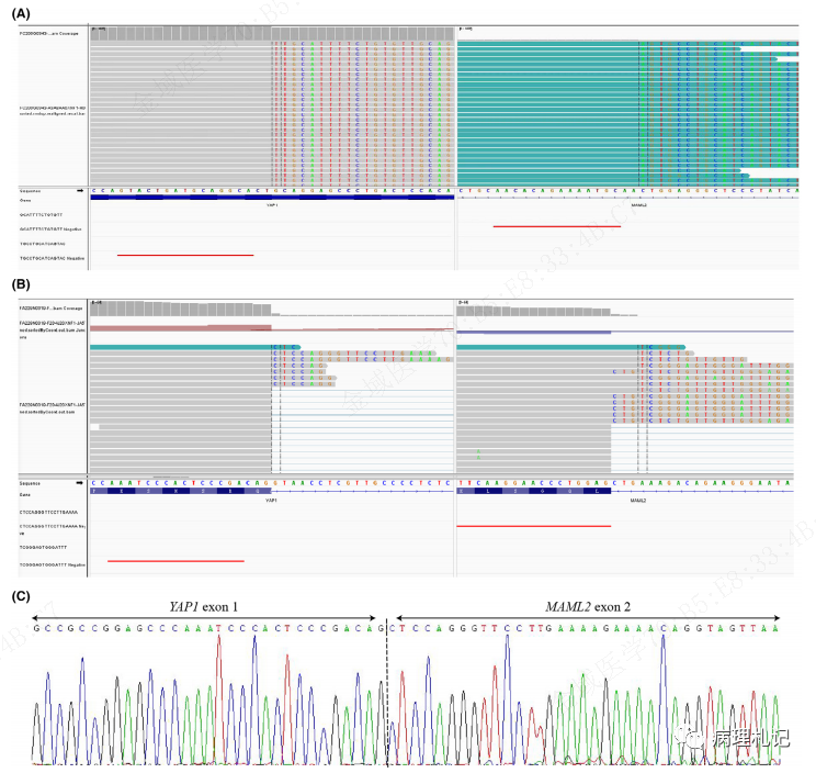 病理视角|YAP1 C端表达缺失作为化生胸腺瘤的辅助标志_医学界-助力医生临床决策和职业成长