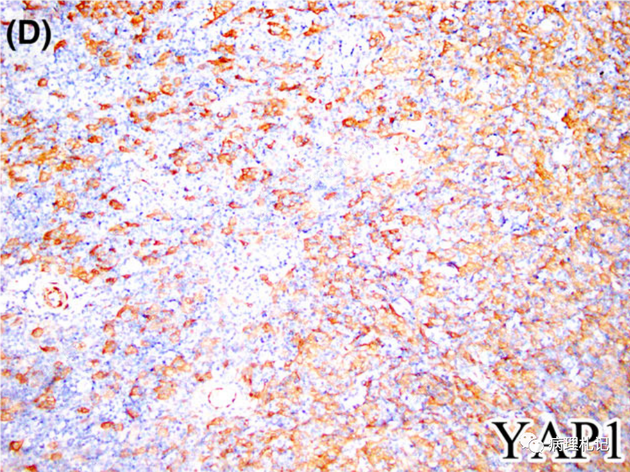 病理视角|YAP1 C端表达缺失作为化生胸腺瘤的辅助标志_医学界-助力医生临床决策和职业成长