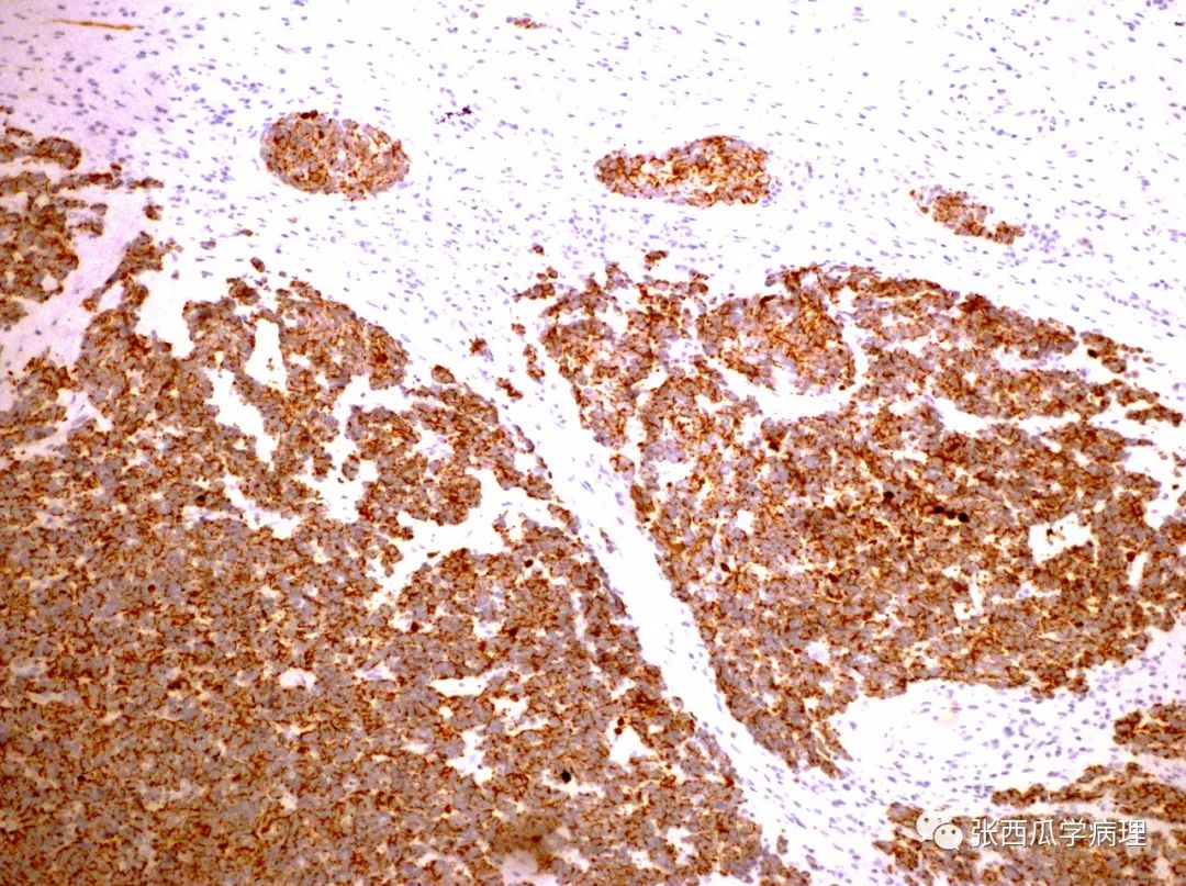 阴道壁肿瘤呈实性巢状，浸润性生长，CK7、CK8/18皆表达，该诊断为？_医学界-助力医生临床决策和职业成长