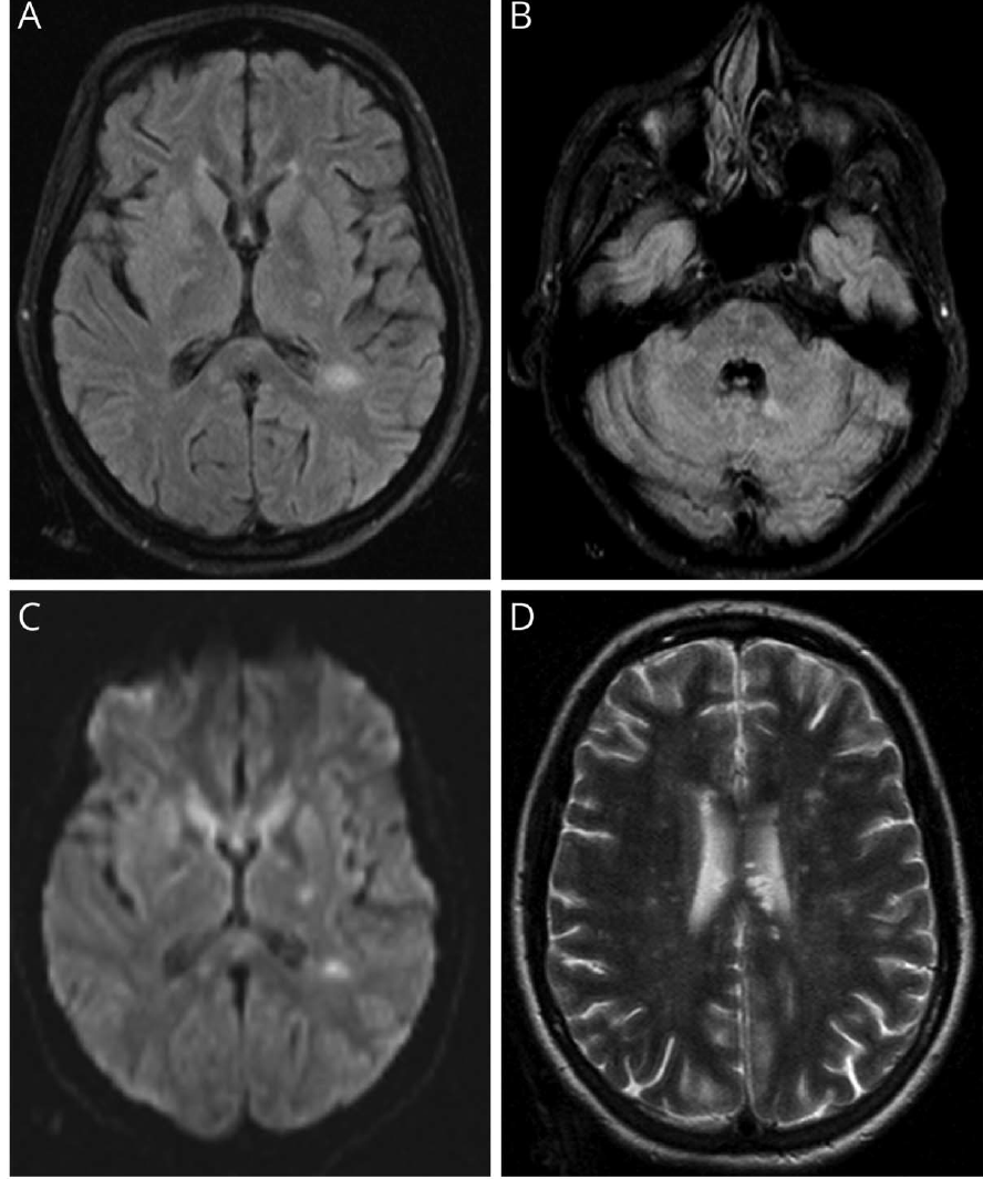 Susac综合征1例_医学界-助力医生临床决策和职业成长