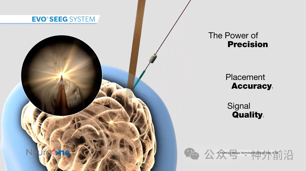 首款SEEG引导的脑部消融系统获批FDA_医学界-助力医生临床决策和职业成长