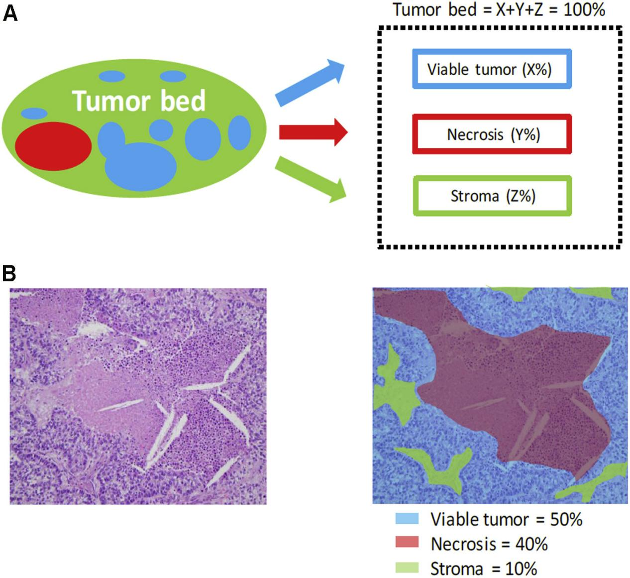 肺癌病理诊断容易混淆的若干问题_医学界-助力医生临床决策和职业成长