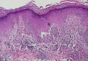 全身沿Blaschko线分布的褐色斑疹，会是什么病？|看图诊断_医学界-助力医生临床决策和职业成长