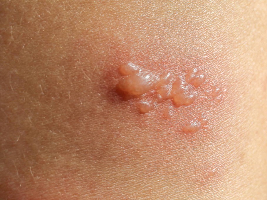 前方高能预警，全是疱疱惹的祸_医学界-助力医生临床决策和职业成长