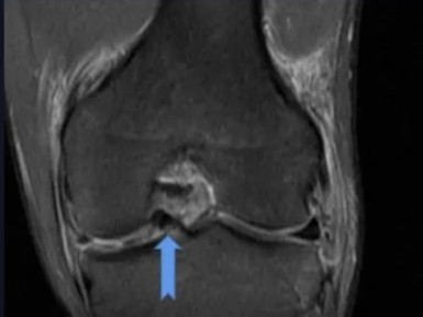 半月板后根撕裂分型图解_医学界-助力医生临床决策和职业成长