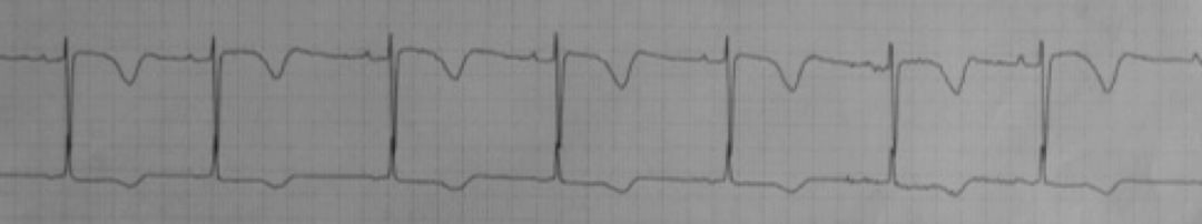 房颤变室速，这样用药太凶险_医学界-助力医生临床决策和职业成长
