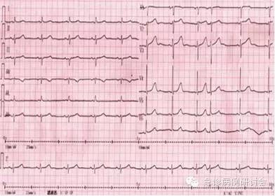 心电图明显提示ACS，诊断怎么就错了呢？！_医学界-助力医生临床决策和职业成长