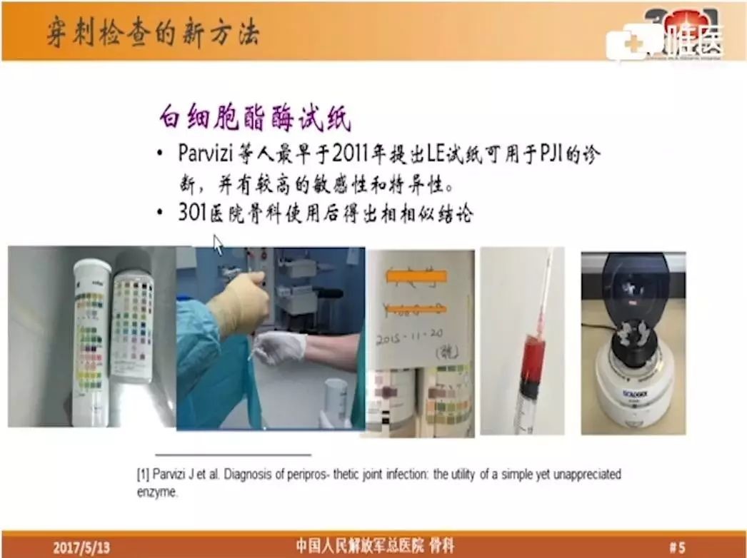 假体感染（PJI）鉴别诊断及新技术_医学界-助力医生临床决策和职业成长