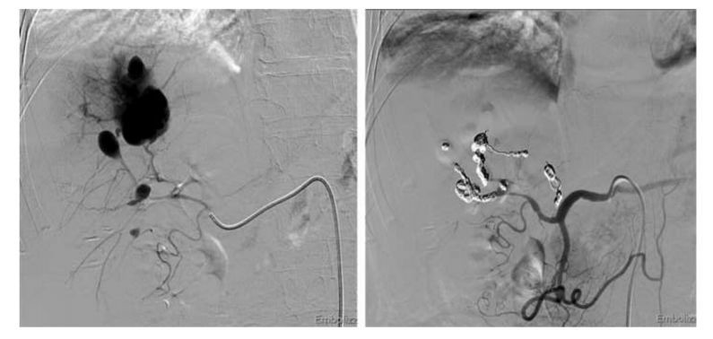 明枪易躲，暗箭难防丨ERCP术后罕见并发症_医学界-助力医生临床决策和职业成长