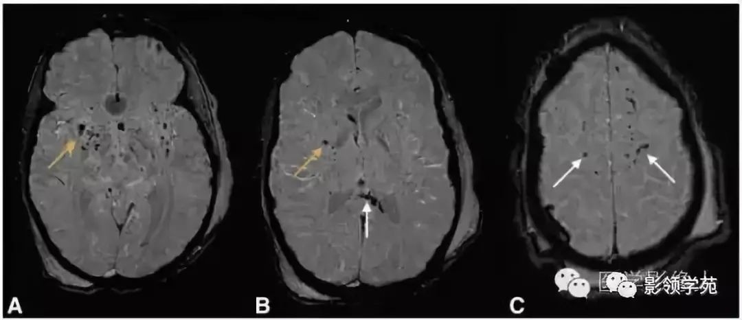 一网打尽脑微出血病变-SWI成像_医学界-助力医生临床决策和职业成长