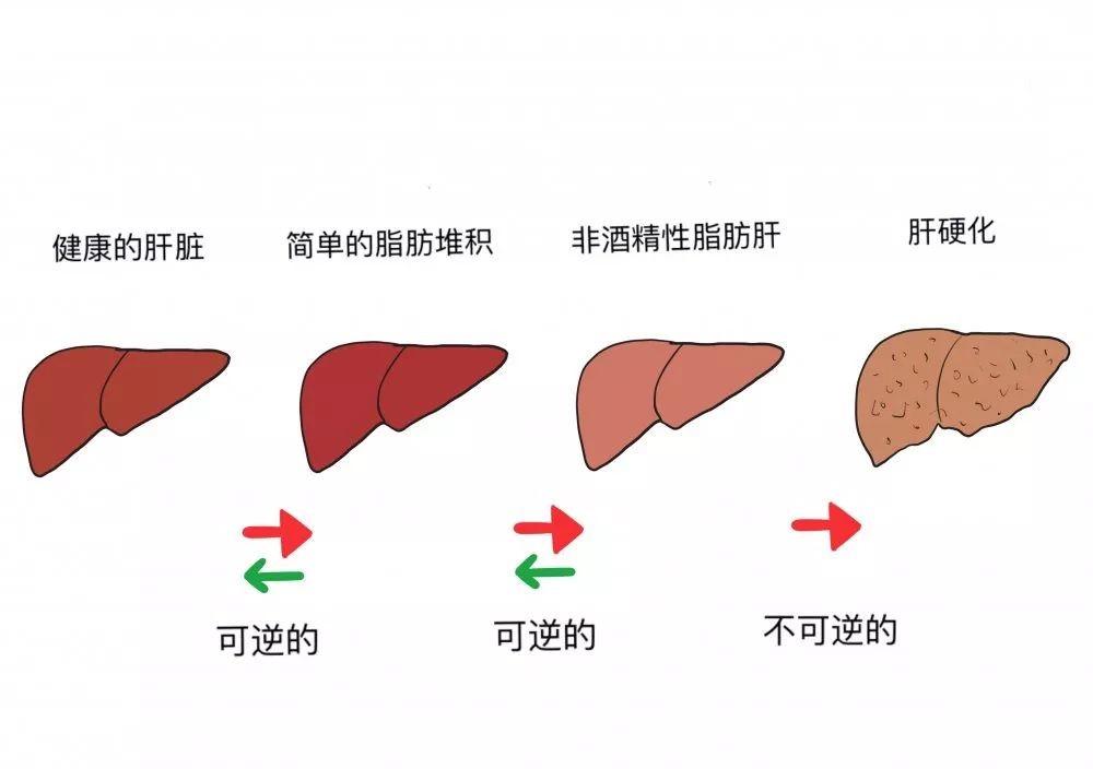 【原创】没得过肝炎,为什么会有肝硬化?医学界 助力医生临床决策和职业成长