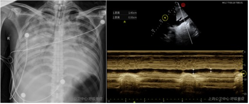ARDS猛烈来袭，ECMO引而不发_医学界-助力医生临床决策和职业成长