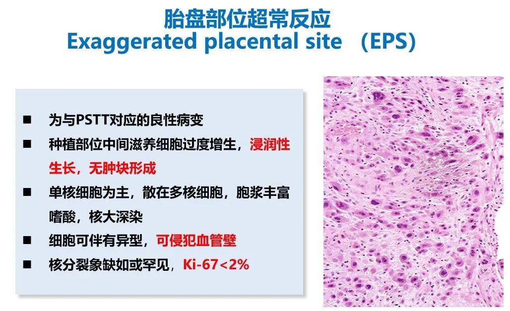 胎盘部位滋养细胞肿瘤（PSTT）如何诊断？_医学界-助力医生临床决策和职业成长
