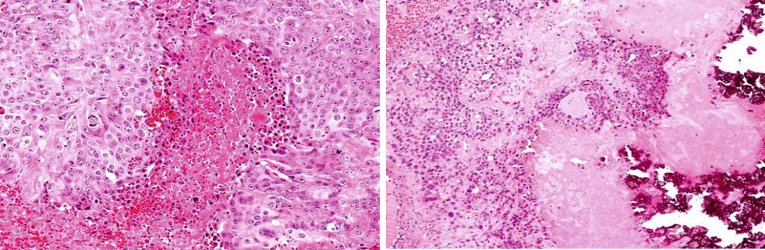 胎盘部位滋养细胞肿瘤（PSTT）如何诊断？_医学界-助力医生临床决策和职业成长