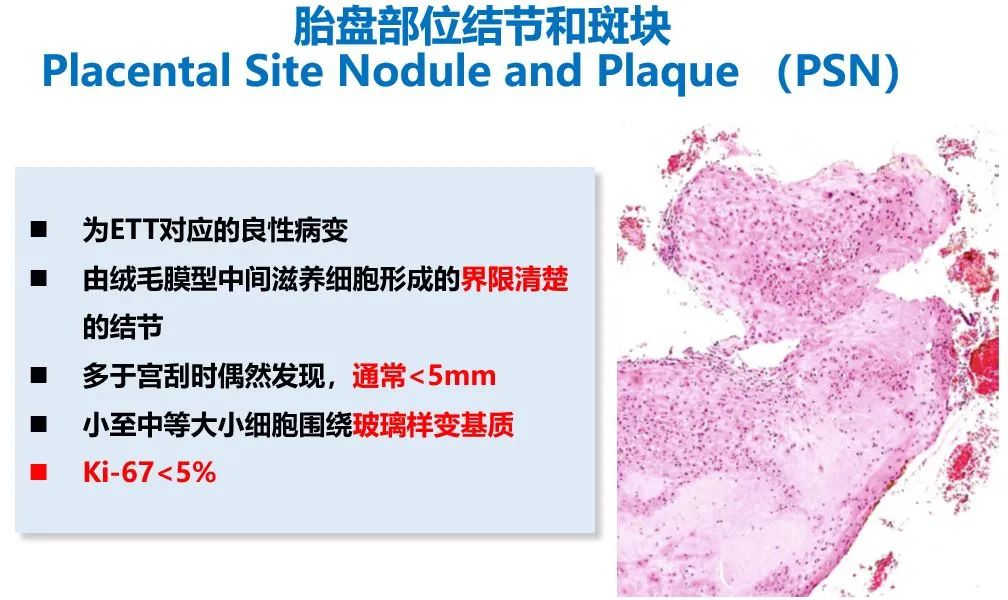 胎盘部位滋养细胞肿瘤（PSTT）如何诊断？_医学界-助力医生临床决策和职业成长