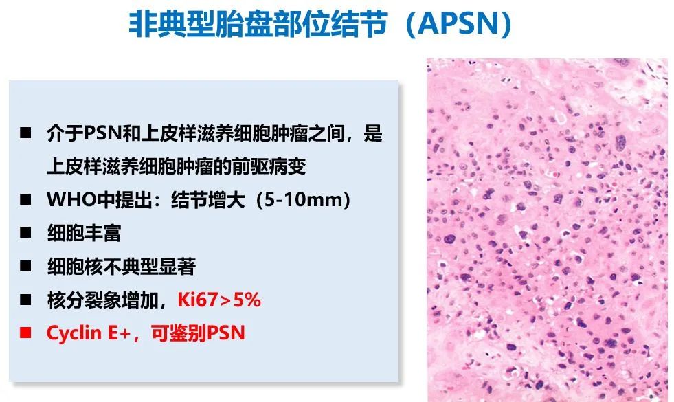 胎盘部位滋养细胞肿瘤（PSTT）如何诊断？_医学界-助力医生临床决策和职业成长