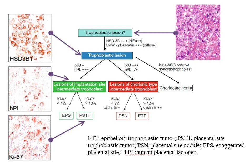 胎盘部位滋养细胞肿瘤（PSTT）如何诊断？_医学界-助力医生临床决策和职业成长