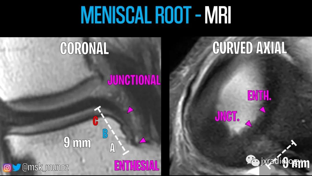 半月板后根撕裂分型图解_医学界-助力医生临床决策和职业成长