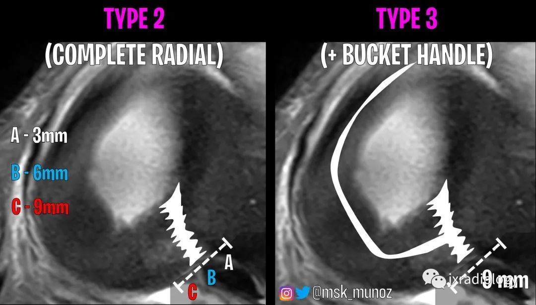 半月板后根撕裂分型图解_医学界-助力医生临床决策和职业成长