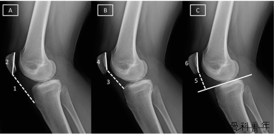平台-髌骨角（PPA）_医学界-助力医生临床决策和职业成长