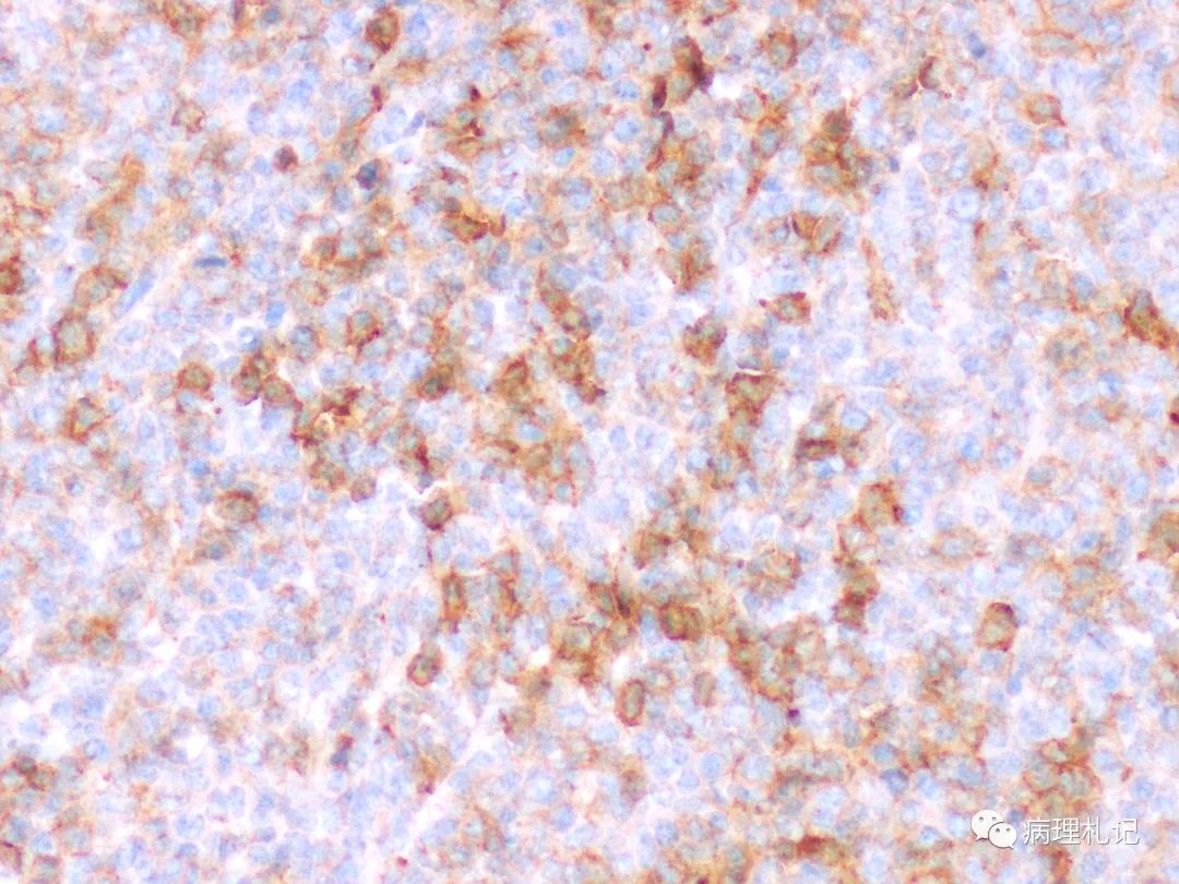 这种罕见的肉瘤类型可以出现在年轻人，但也有老年人_医学界-助力医生临床决策和职业成长