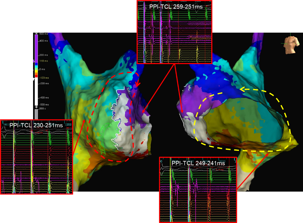 心脏外科术后出现房性心动过速，如何消融？_医学界-助力医生临床决策和职业成长