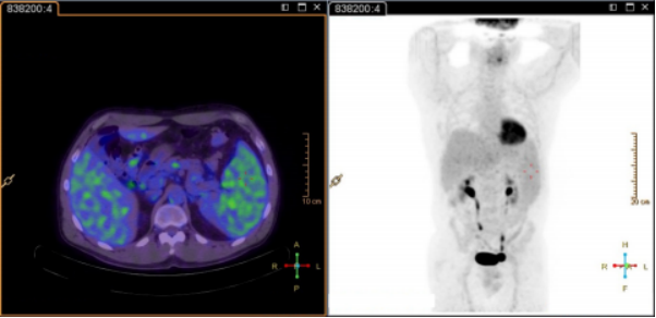 男子血管水肿三度入院未明病因，突发呼吸困难……_医学界-助力医生临床决策和职业成长