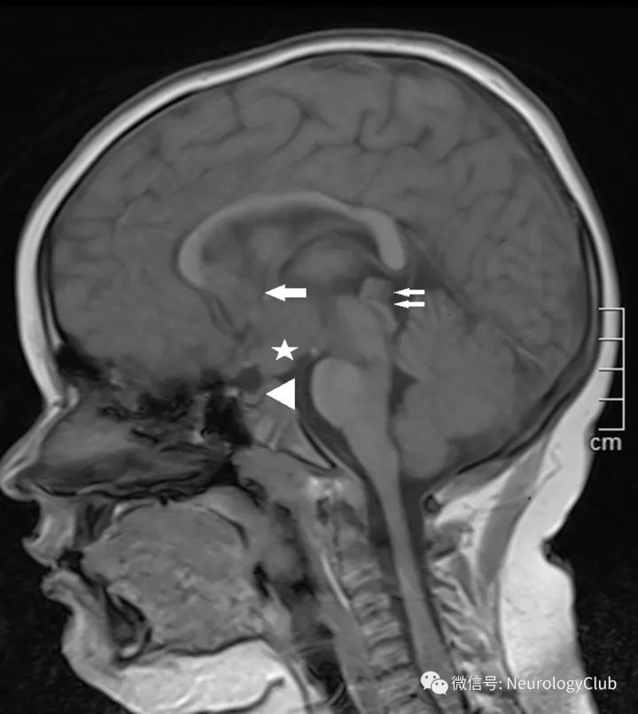 影像挑战：6岁男孩，颅内多发病变（结果公布）_医学界-助力医生临床决策和职业成长