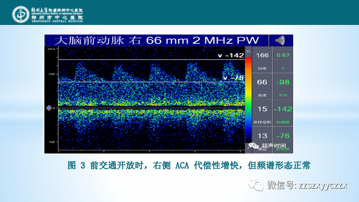 神经内科医生应该了解的 TCD及TCCD知识，一文读懂_医学界-助力医生临床决策和职业成长
