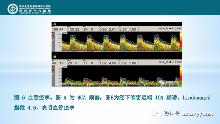 神经内科医生应该了解的 TCD及TCCD知识，一文读懂_医学界-助力医生临床决策和职业成长