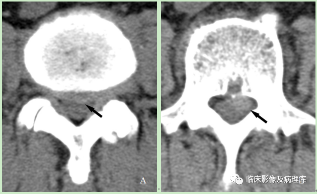 椎间盘突出、脱出_医学界-助力医生临床决策和职业成长