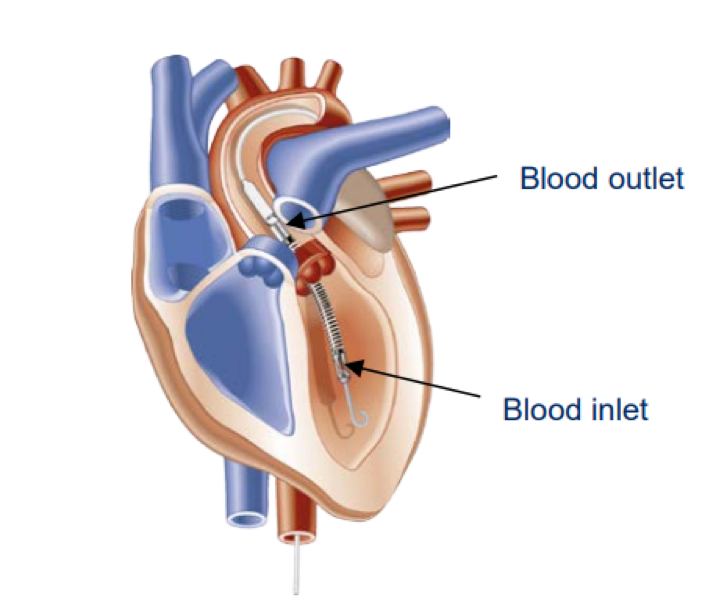 CCI创新周讯| Impella基本结构和常见并发症_医学界-助力医生临床决策和职业成长