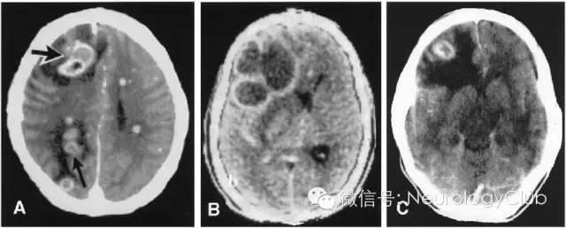 神经影像：开环征（open-ring sign）_医学界-助力医生临床决策和职业成长