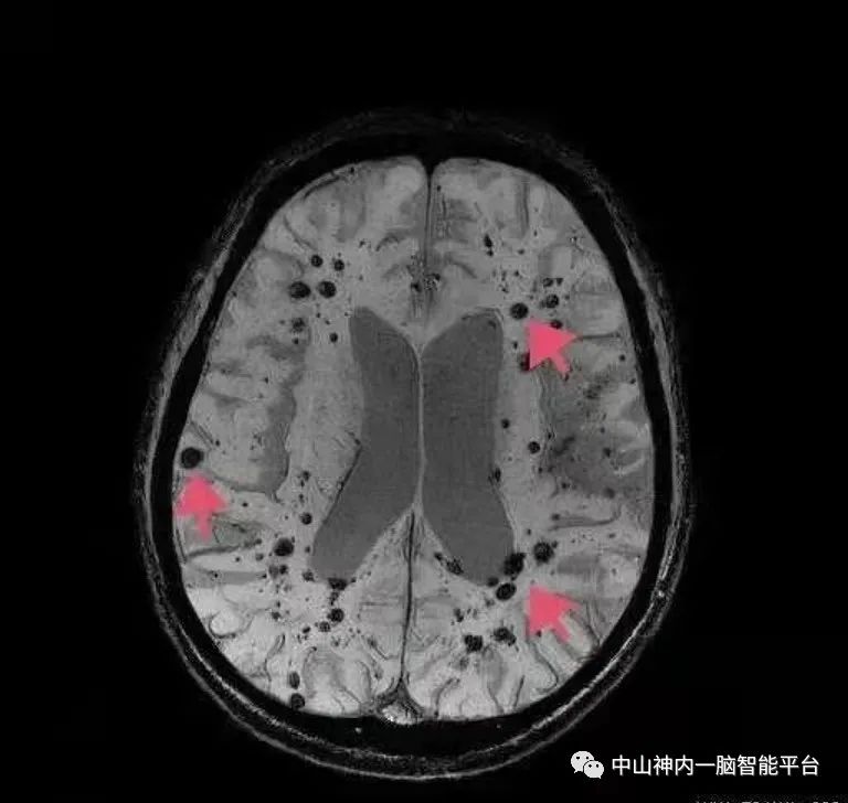 脑微出血=脑出血吗？_医学界-助力医生临床决策和职业成长