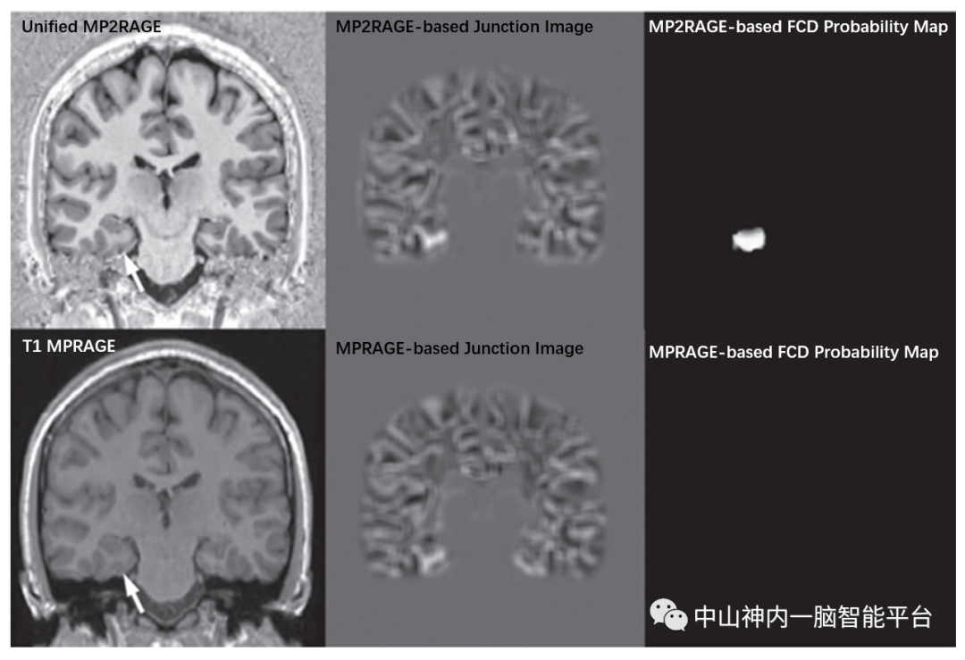 利用MP2RAGE序列实现FCD的智能识别_医学界-助力医生临床决策和职业成长