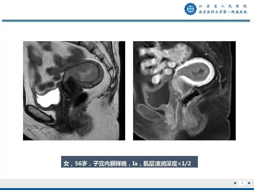 子宫内膜癌FIGO分期与功能磁共振成像_医学界-助力医生临床决策和职业成长