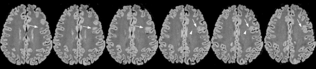 17岁女性发作性面部麻木6年余，病例解析_医学界-助力医生临床决策和职业成长
