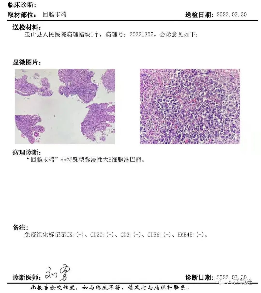 回肠末端弥漫大B细胞淋巴瘤（DLBCL）一例诊断分享_医学界-助力医生临床决策和职业成长