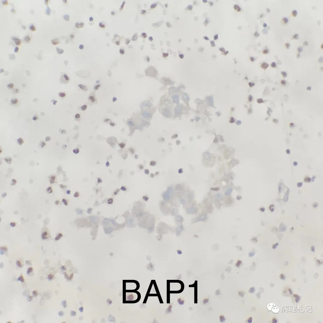 病理视角|细胞学BAP1表达缺失的非典型恶性间皮瘤_医学界-助力医生临床决策和职业成长