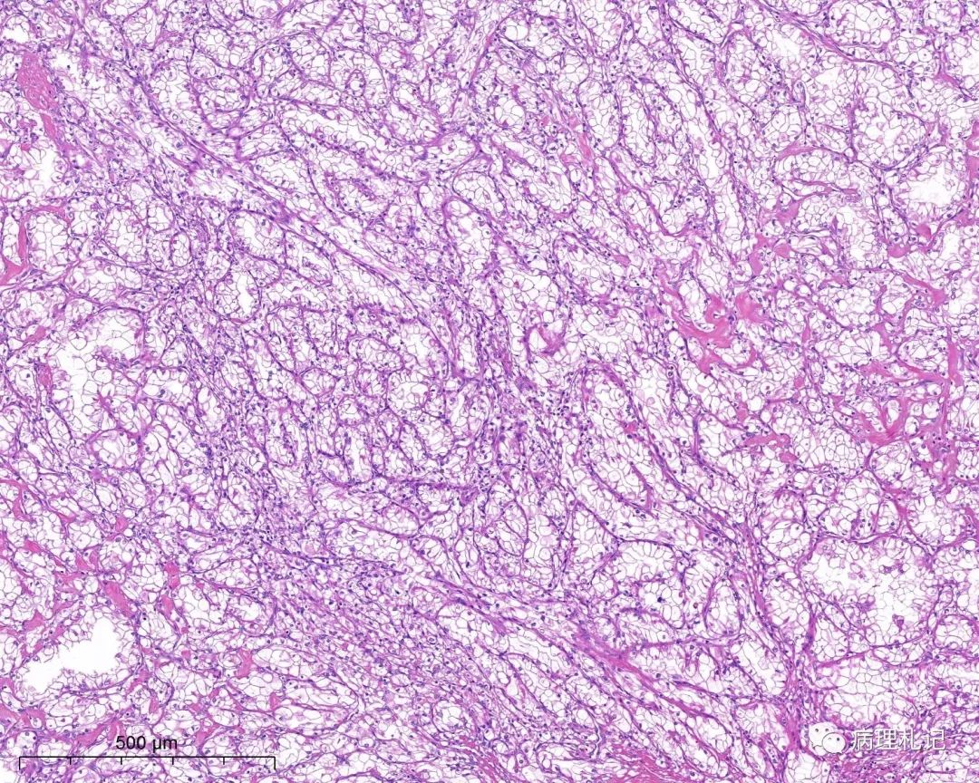 病理视角|细胞学BAP1表达缺失的非典型恶性间皮瘤_医学界-助力医生临床决策和职业成长